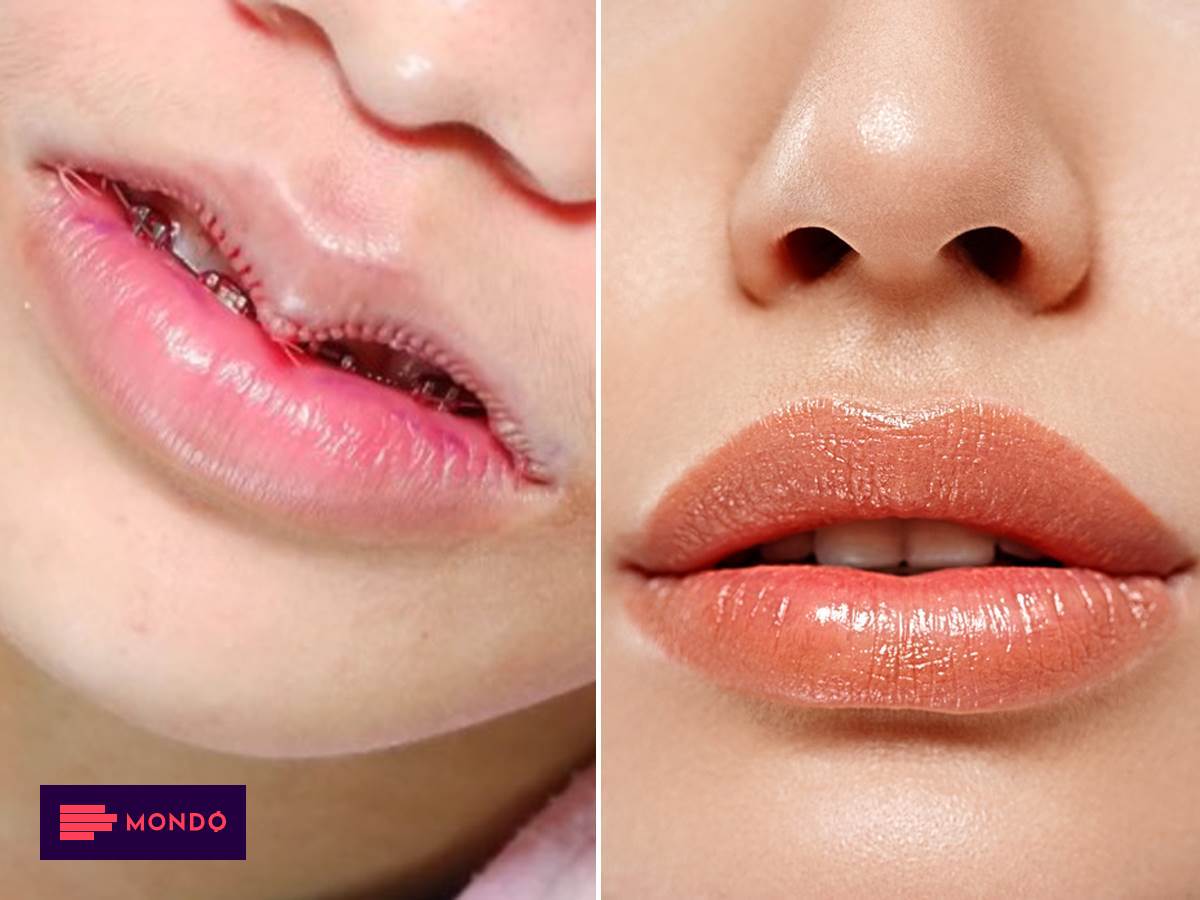 operacija galebove usne | Magazin | Lifestyle